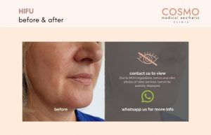 HIFU: Benefits, Side Effects and Cost Guide (2024)