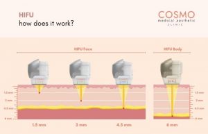 HIFU: Benefits, Side Effects and Cost Guide (2024)