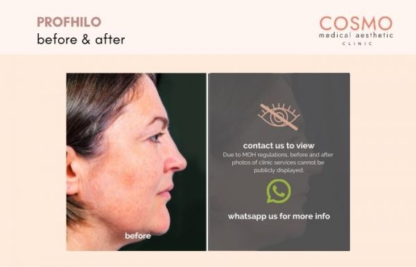 Profhilo: Benefits, Side Effects, and Cost Guide (2025)