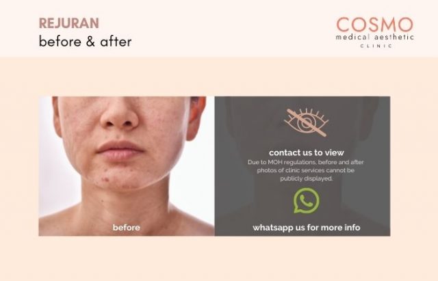 Rejuran: Benefits, Side Effects, and Cost Guide (2025)