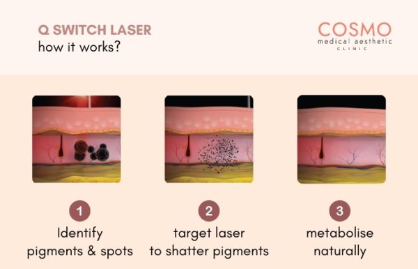 Q Switch Laser: Benefits, Side Effects, and Price Guide (2025)