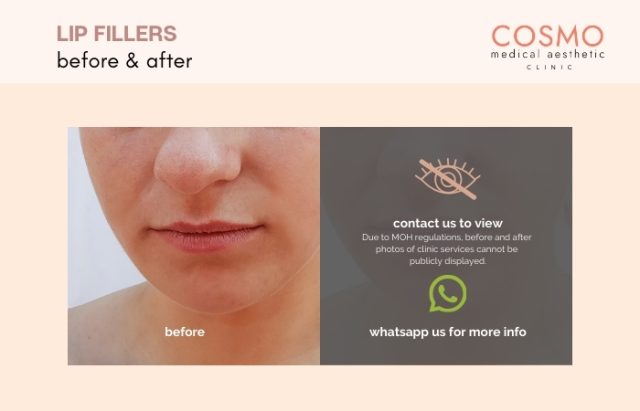 Lip Fillers: Benefits, Side Effects, and Price Guide (2025)