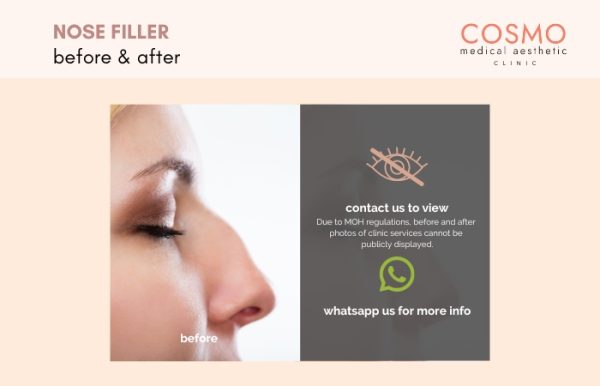 Nose Fillers: Benefits, Side Effects, and Price Guide (2025)