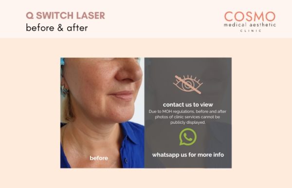 Q Switch Laser: Benefits, Side Effects, and Price Guide (2025)